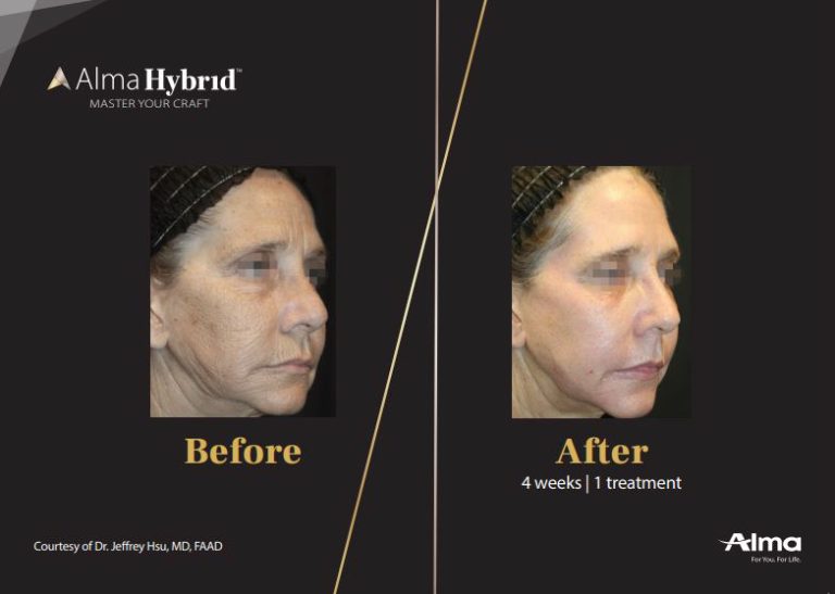 Introducing the revolutionary Alma Hybrid Laser: KM Surgical - Metropol